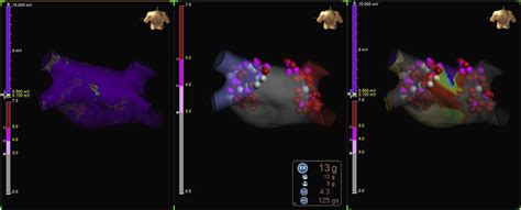 Lesion Index Lsi Guided Ablation Using The Ensite System Abbott Download Scientific