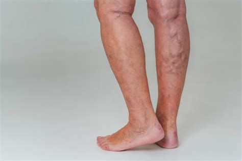 Pierna Con Varices Causas Síntomas Y Tratamientos Clinica Simarro