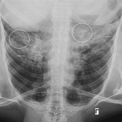 Chest Radiograph Postero Anterior View Shows Bilateral Lower Zone Download Scientific Diagram