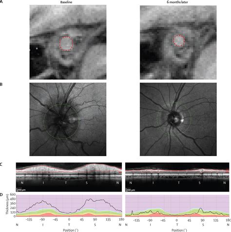 Optic Neuritis The Lancet Neurology