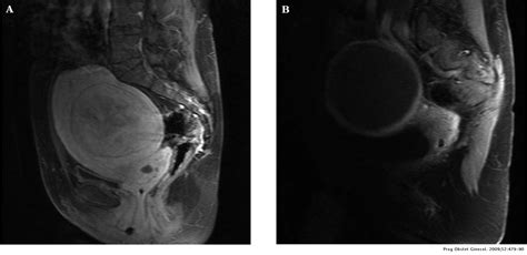 Embolización De Las Arterias Uterinas En El Tratamiento Del Mioma