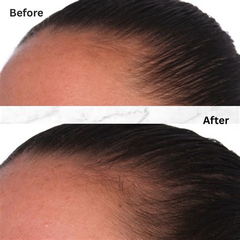 Before And After Collagen Visible Results For Skin Wrinkles And Hair
