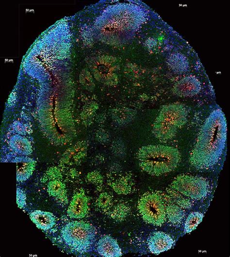 two thousand human brains yield clues to how genes raise risk for