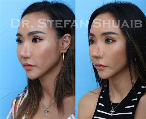 Revision Rhinoplasty Archives Dallas Facial Plastic Surgery Center