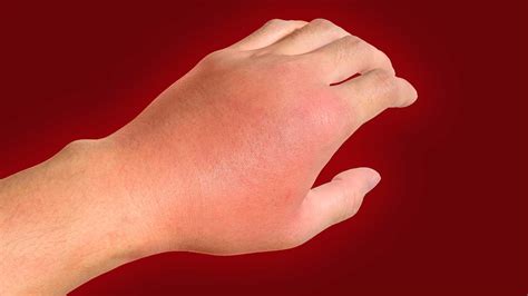 Cellulitis Thumb