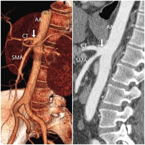 Variations Of The Celiac Trunk In Mexican Population By Mdct
