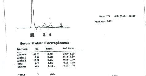 Jms Adventure With Multiple Myeloma Spep M Spike Values From January 16 2012
