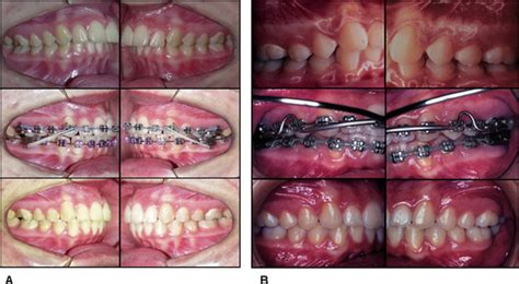 Root Resorption In Class Ii Malocclusion Treatment With Class Ii