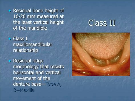 Ppt Complete And Partial Edentulism Powerpoint Presentation Free