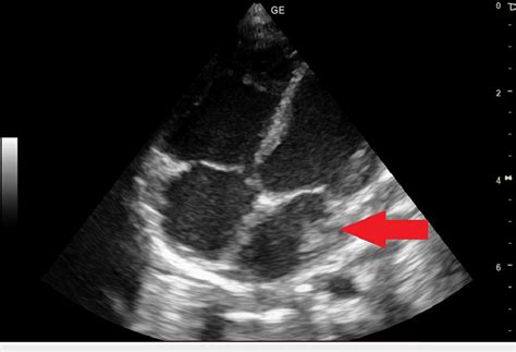Ultrasound Showing A Rare Association Of Intracardiac Appendage In The Download Scientific