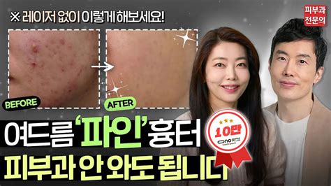 여드름 패인 흉터 피부과 시술없이 효과 보는 방법 Youtube