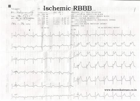 Is There An Entity Called Ischemic Rbbb Drsvenkatesan Md