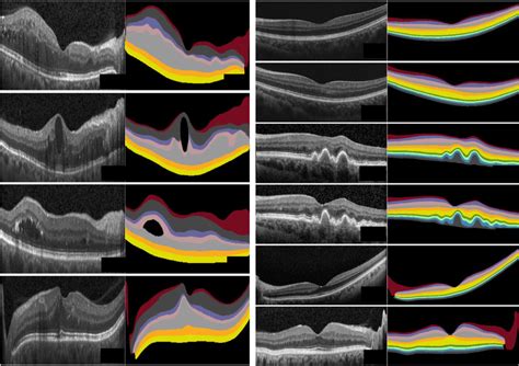 Left Image Retinal 7 Layers Segmentation Results Moradi Et Al