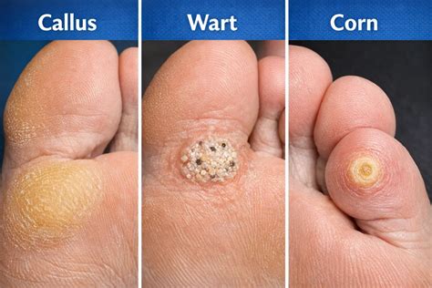 Callus Vs Wart Vs Corn Key Differences And Treatments