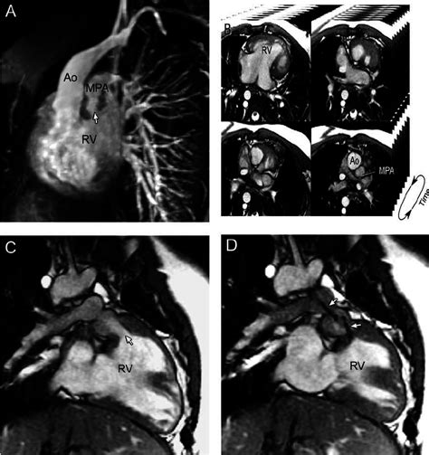 Mri Evaluation Of Heterotaxy Syndrome Common Av Canal And