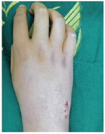 Figure 1 From Treatment Of Fifth Metacarpal Neck Fracture In Adolescents With Minimally Invasive