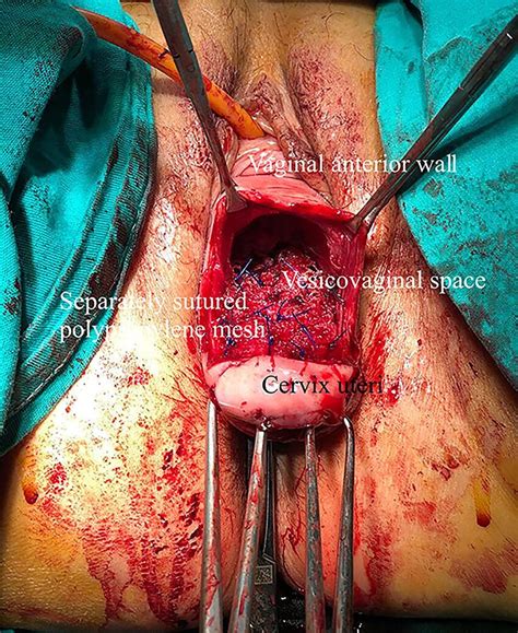 The Middle Part Of The T Shaped Mesh With The Dimensions Of Cm Is Download Scientific