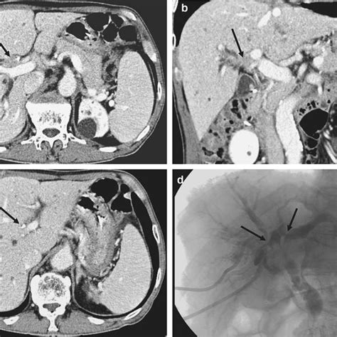 A D A 65 Year Old Male With Hilar Cholangiocarcinoma Bismuth Type Iv Download Scientific