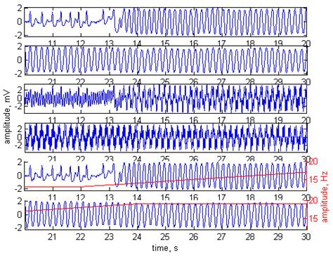 Adaptive Filtering Applied On A Patient With Ventricular Fibrillation Download Scientific
