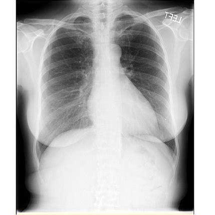 CT Chest Demonstrating Diffuse Interstitial Prominence With Fine Download Scientific Diagram