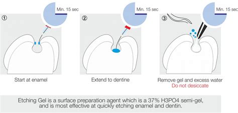 Acid Etching Technique In Dentistry At John Bing Blog