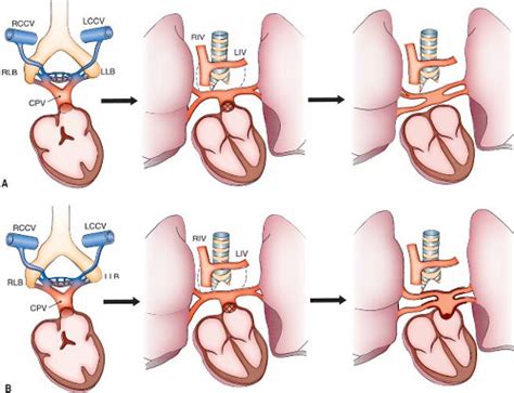 Anomalies Of The Pulmonary Veins Thoracic Key