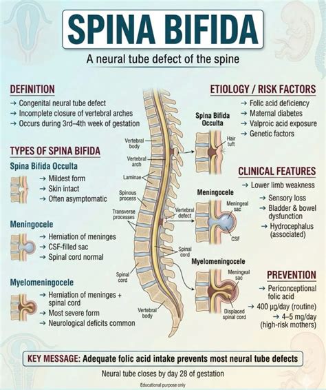 Spina Bifida Definition Causes Diagnosis And Management Dr S 0