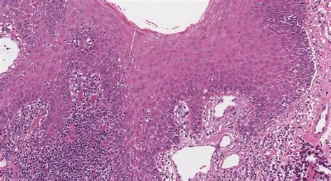 Acute Mucositis Of The Oral Cavity Ottawa Atlas Of Pathology