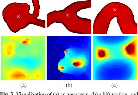 Figure 3 From Aneurysm Detection In 3d Cerebral Angiograms Based On Intra Vascular Distance