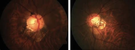 Posterior Staphyloma High Risk Factor Of Myopic Maculopathy