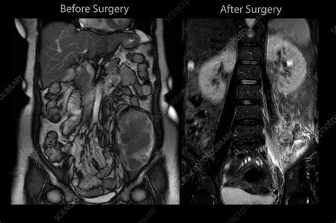 Dedifferentiated Liposarcoma Before And After Surgery Ct Scans Stock