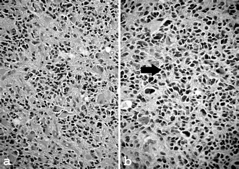A Pleomorphic Glial Cells With Hyperchromatic Nuclei And Atypical Download Scientific Diagram