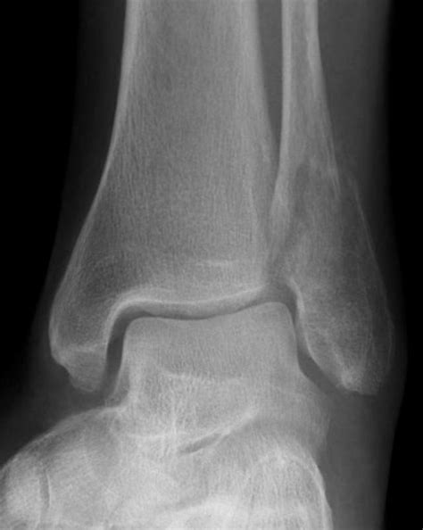 Fibula Fractures The Bone School