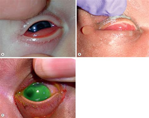 Conjunctivitis Of The Newborn Clinical Tree