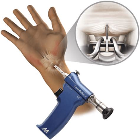 Endoscopic Carpal Tunnel Release