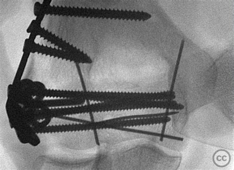 Dubberly 2b Articular Humerus Fracture Skinny Wire And Radial Plate