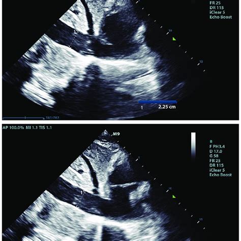 Cvp Range Wise Correlation Between Cvp And Rv Ivcd Download