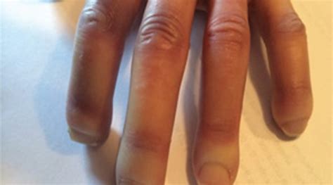 Causes Of Scleroderma Archives Planet Ayurveda