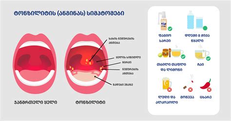 ბიოქიმფარმი ტონზილიტი გლანდების ანთება და ფაგოთერაპია