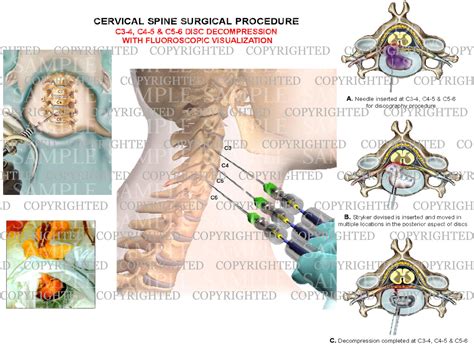 3 Level C3 4 C4 5 And C5 6 Cervical Spine Decompression Surgery Wit