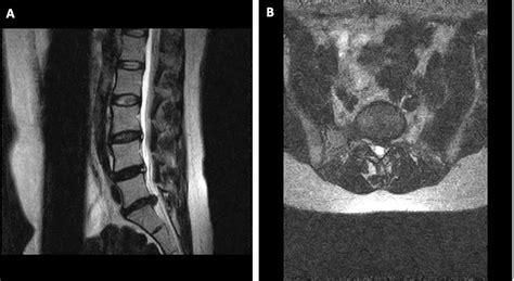 Recurrent Herniated Disc At The Same Level In A Young Patient