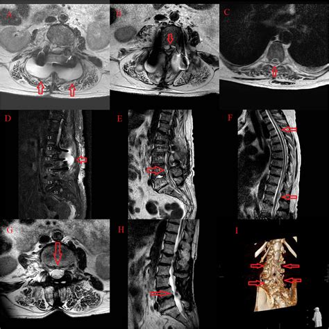 Emergent Mri Demonstrated Pyogenic Spondylodiscitis With Paraspinal And