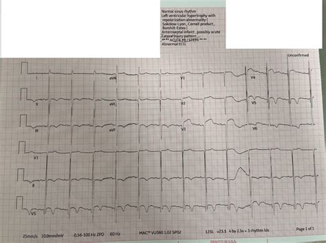 Acute Mistemi Activate The Cath Lab If The Patient Has Chest
