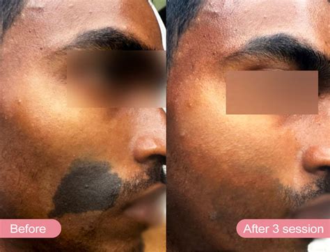 How Can I Remove My Birthmark