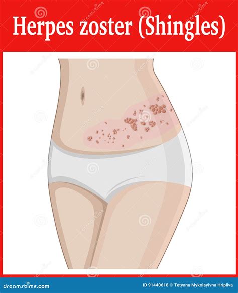 Shingles Disease Clipart