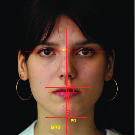 Transversal Parameters Of Soft Tissue Structures On Face Front On