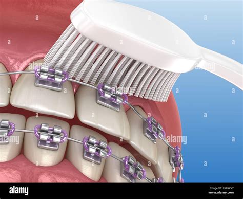 Toothbrush Cleaning Braces Process Medically Accurate 3d Illustration Of Oral Hygiene Stock