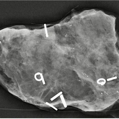 Intra Operative Specimen Mammogram Showing Residual Micro Calcification