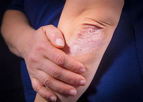 Managing Psoriasis Flare Ups Tips For Seniors In Home Senior Care In