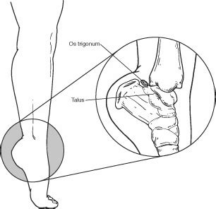 Os Trigonum Syndrome Foot Health Facts
